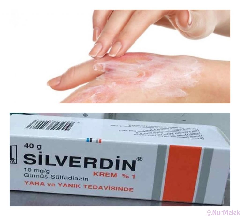 Yanığa İyi Gelen En Sık Kullanılan 5 Krem